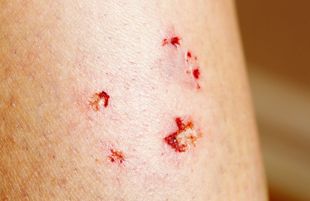 Hepatitis Resources | Hepatitis QLD